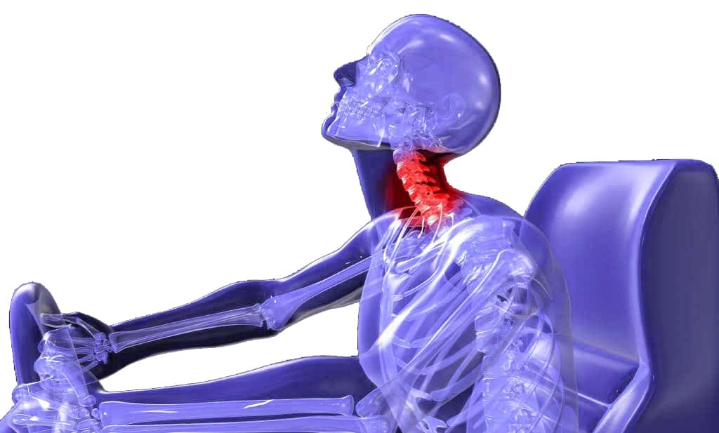 Esguince cervical o latigazo. Cómo superarlo con la quiropráctica.